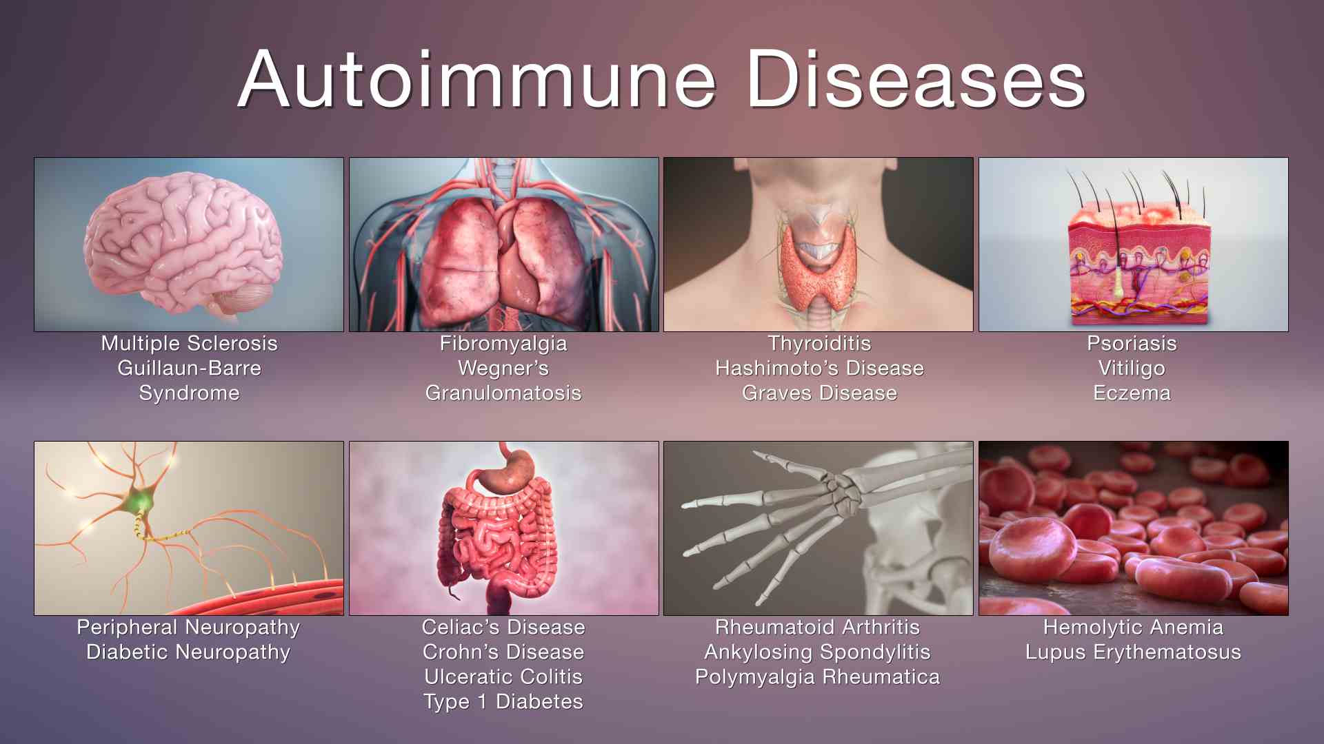 Autoimmune Disease: Mechanism of autoimmunity, Types and...